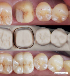 Digital Impressions | Precise and Comfortable Dental Scans