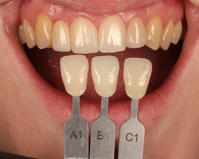 Dental Shade Taking Service | GoDigital Dental Lab